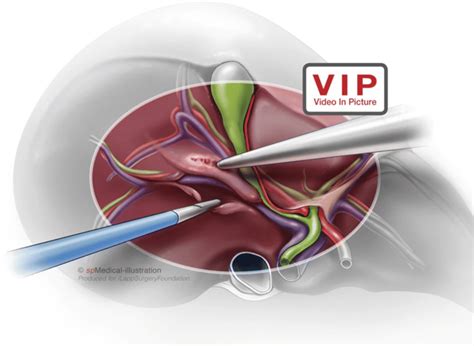 Image Showing The Glissonean Approach For Laparoscopic Right Posterior Download Scientific