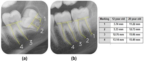 Figure 1 From Age Assessment Through Root Lengths Of Mandibular Second And Third Permanent