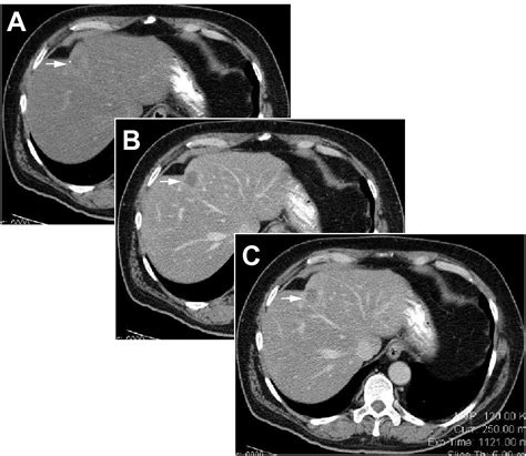 Contrast Enhanced Ct Scan To Diagnose Intrahepatic Cholangiocarcinoma