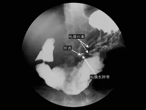 5 分钟读懂消化道造影片