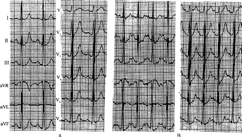 第一节 Q T间期缩短 心血管 医学