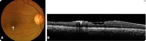 Color Fundus Photographs A And Oct B Post Op Week 1 Download Scientific Diagram