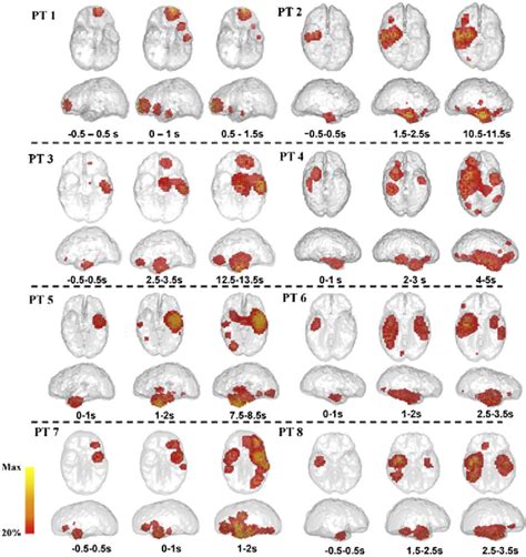 Figure 5 From Dynamic Imaging Of Ictal Oscillations Using Non Invasive High Resolution Eeg