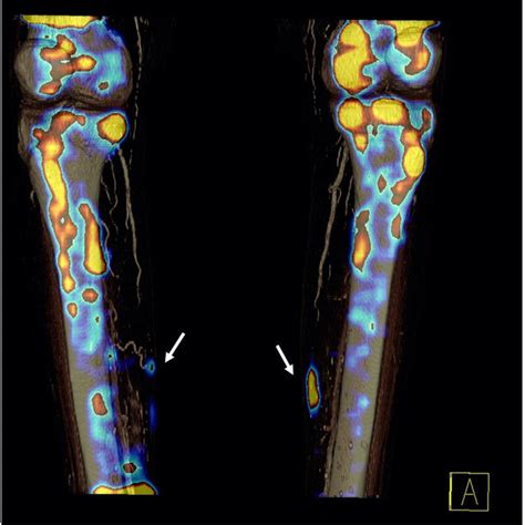 Bone Spect Coronal A And Axial B Sections Bone Spectct Coronal
