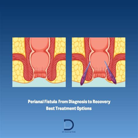 Perianal Abscess And Anal Fistula Causes Symptoms Andtreatment د دعد
