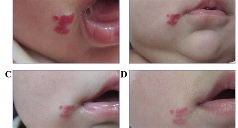 Причины появления гемангиомы у взрослых и детей