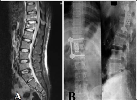 Compression Fracture Mri At Rhonda Freese Blog