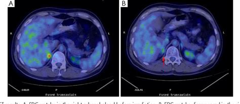 Figure 1 From Rare Myeloid Sarcomaacute Myeloid Leukemia With Adrenal
