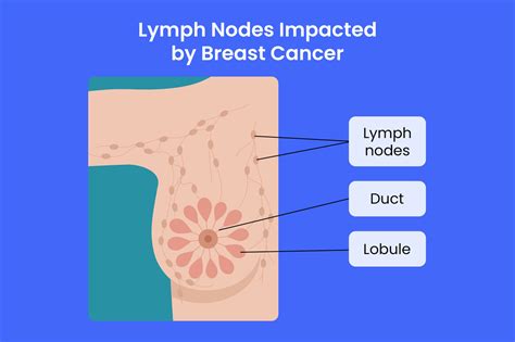 Internal Bleeding And Swollen Lymph Nodes Causes Lymph Node