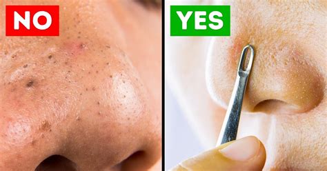 Ways To Effectively Remove And Avoid Blackheads