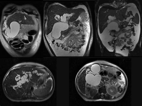 Sabin Salim On Linkedin 42y M Patient With H O Continuous Swelling Of Abdomen For 10 Days K C O…