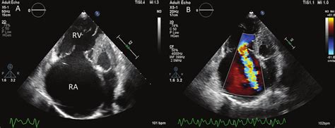 Echocardiogram In Modified Apical Four Chamber View Revealing Dilated