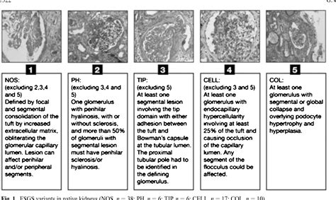 Figure 1 From Recurrence Of Nephrotic Syndrome After Transplantation In
