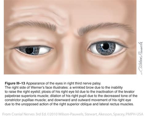 Oculomotor Nerve Palsy Third Cranial Nerve Oculomotor Nerve Palsy