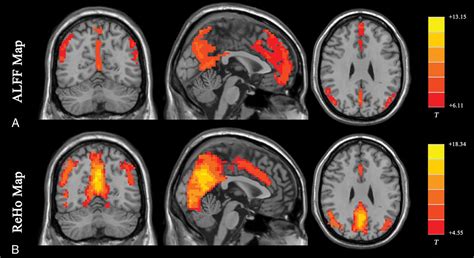 Resting State Functional Mri Everything That Nonexperts Have Always Wanted To Know American