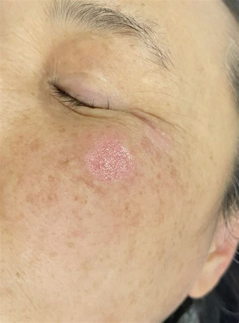 내돈내산🫶🏻 흑자제거 부산리팟레이저 후기 네이버 블로그