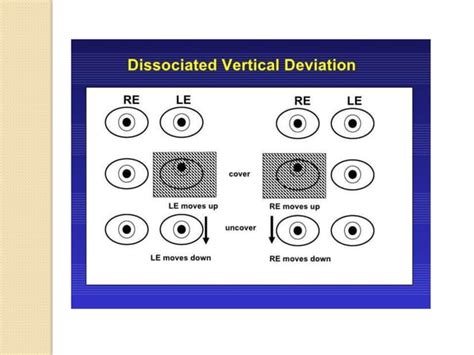 Dissociated Vertical Deviation Ppt