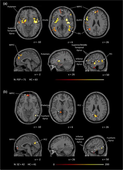 Putamen Resting State Functional Connectivity Patient Versus Control Download Scientific