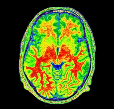 Positron Emission Tomography Brain