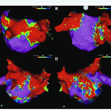 Comparison Of Voltage Maps According To Types Of Recurrent Ata Coloured Download Scientific