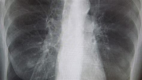 Emphysema Lung X Ray Spot The Pneumothorax Cureus