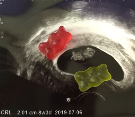 뽀뽀일기 임신 7주차~8주차 증상 젤리곰 확인 그리고 양치덧 네이버 블로그