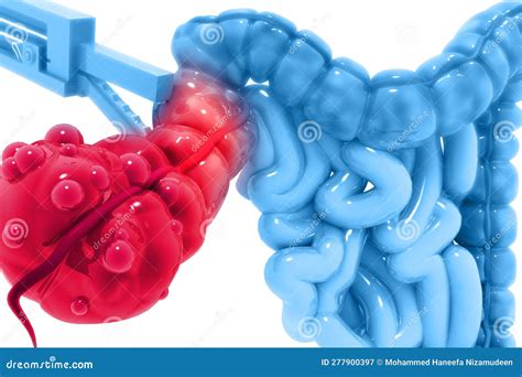 Appendix Surgery Stock Illustration Illustration Of Equipment 277900397