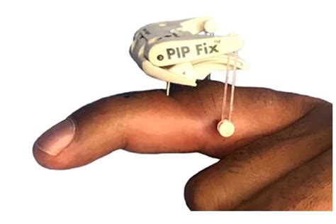 Age Pip Fix Indicated For Dorsal Fracture Dislocations Of Age Pip Fix Indicated For Dorsal Fracture Dislocations Of