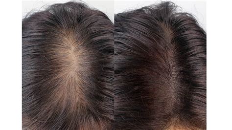 Scalp Micro Pigmentation Smp He Clinic For Men