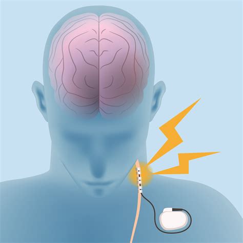 Vagus Nerve Stimulation Neura Library