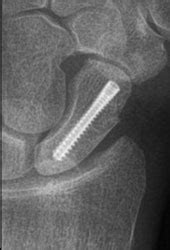 Scaphoid Fracture Treatment In Dallas Tx Hand And Wrist Institute