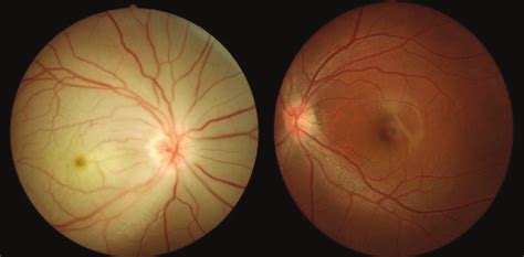 Fundus Examination Shows Diffuse Whitening Retinal Edema Optic Disc Download Scientific