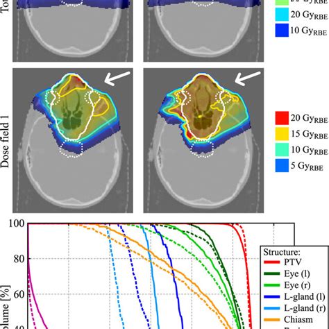 Total Dose Field Dose Field 1 White Arrows Indicate Gantry Angle Download Scientific