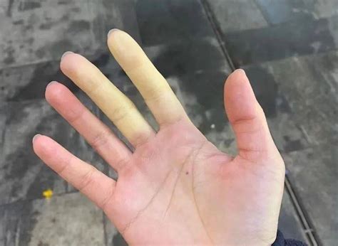 福州小伙手指遇冷就变色，医生：系硬皮病，女性更易中招 皮肤 李先生 双手