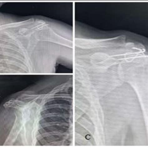 A C Axillary Scapular Y View And Antero Posterior View Of Left