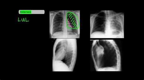 Lobar Atelectasis On Frontal And Lateral Chest X Rays Undergroundmed