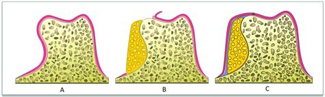 Diagram Showing A Regenerative Technique In An Area With The Bone
