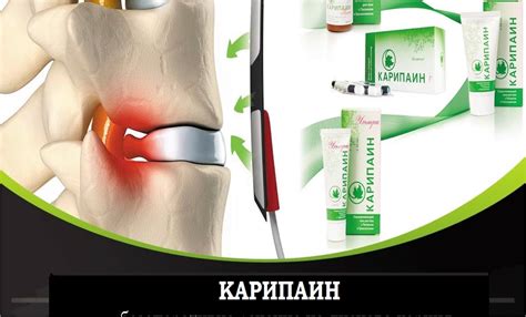 Dr Paskaleva Д р Силвия Паскалева ди физиотерапевт диетолог ЛЕЧЕНИЕ НА ДИСКОВА ХЕРНИЯ