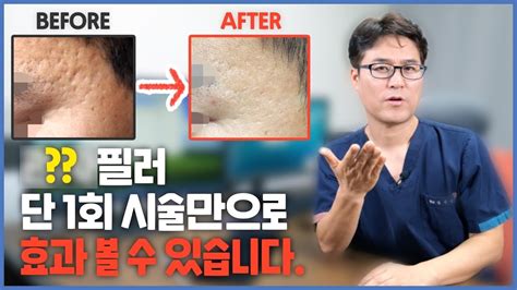 이 시술로 여드름 흉터 효과 본다 골치 아픈 스트레스 여드름흉터 Youtube