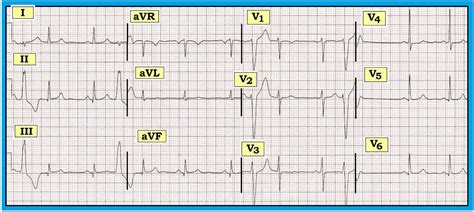 Ecg Interpretation Ecg Blog 68 — Interpolated And Concealed