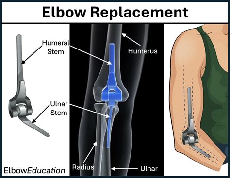 Elbow Replacement Surgery Elbow Education