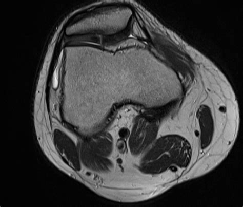 Chondromalacia Patella With Joint Effusion At Martin Goddard Blog