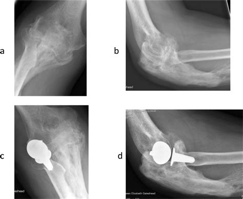 Radiocapitellar Arthroplasty Pmc