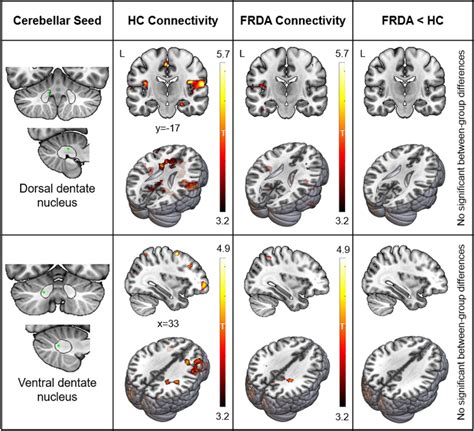 Dentate Nucleuscerebral Cortex Functional Connectivity Leftmost