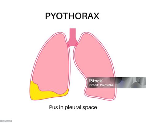 Pyothorax Pleural Empyema Stock Illustration Download Image Now Activity Anatomy Bacterium