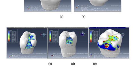 Is Polymerization Shrinkage Stress A Good Thing