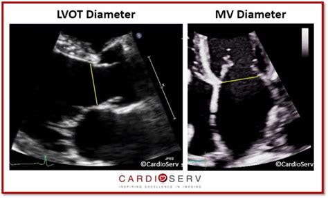 Steps To Quantifying MR Via Stroke Volume Method Cardioserv