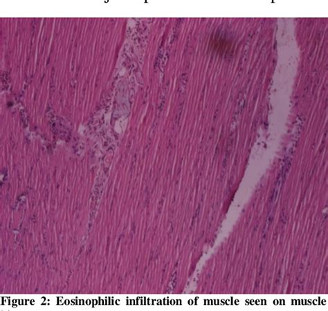 Figure 1 From A Case Of Eosinophilic Myositis In A Patient Of