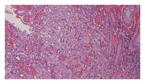 A Colon Hepatic Flexure Tumor Biopsy Moderately Differentiated Download Scientific Diagram
