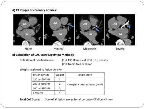 Ct Calcium Scorepptx